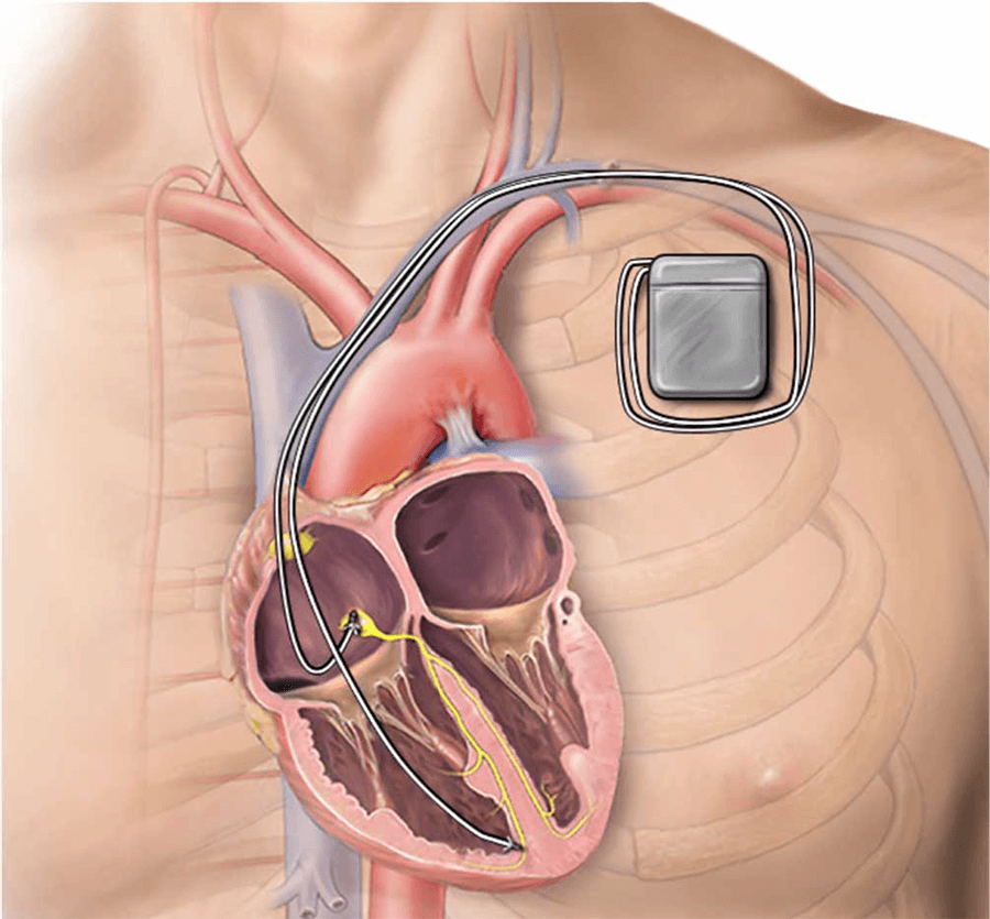 Pacemaker Tri City Cardiology Pacemaker Tri City Cardiology